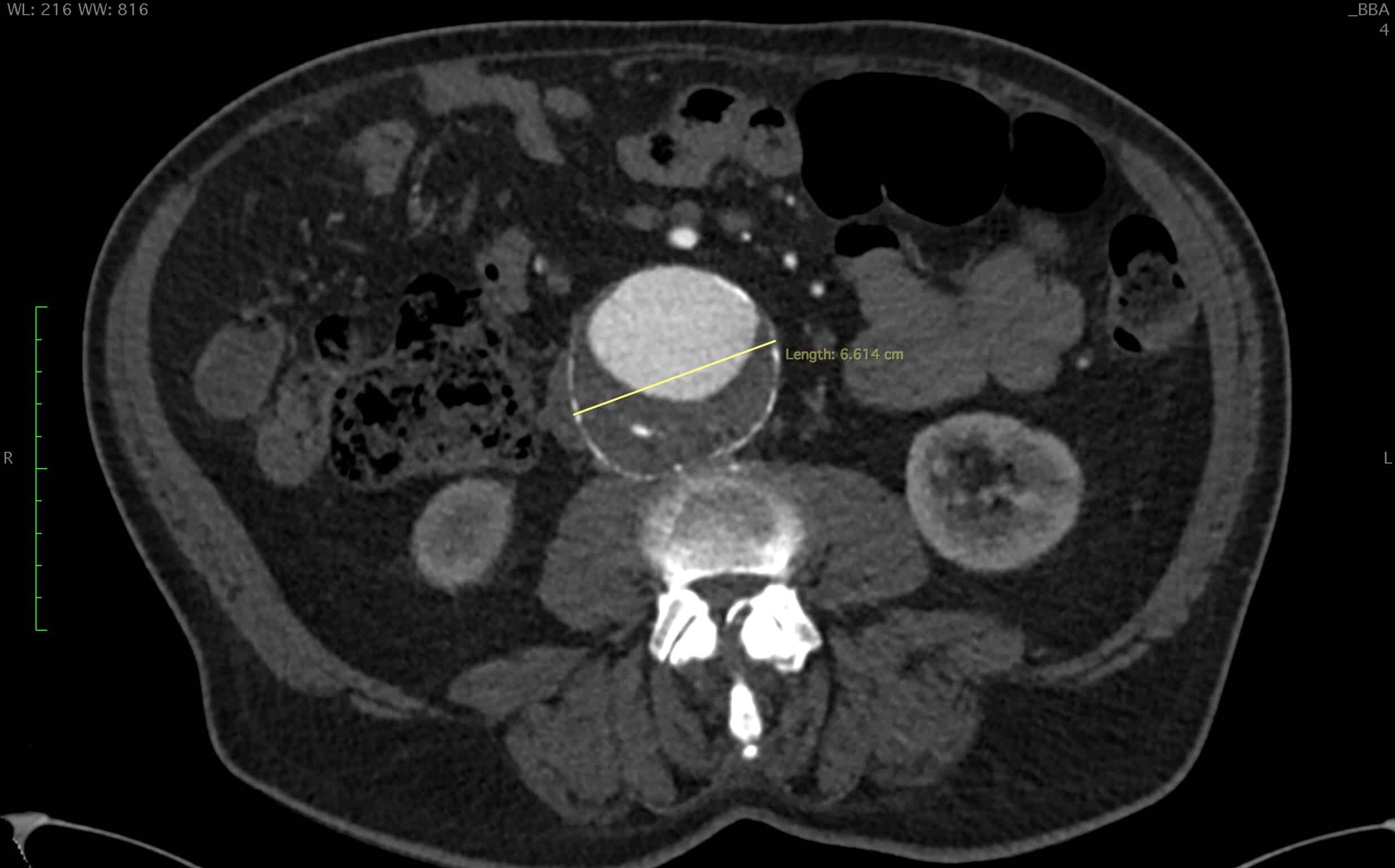 Warum ist eine Vorsorgeuntersuchung der Bauchschlagader wichtig ...