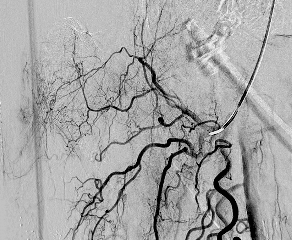 TAPE (Transarterielle periartikuläre Embolisation, Gelenkembolisation ...