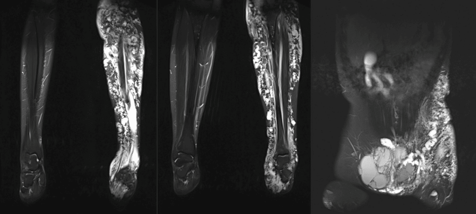 Was ist das Klippel-Trénaunay-Syndrom? - Gefäßmedizin Dr. Wolfgang Matzek